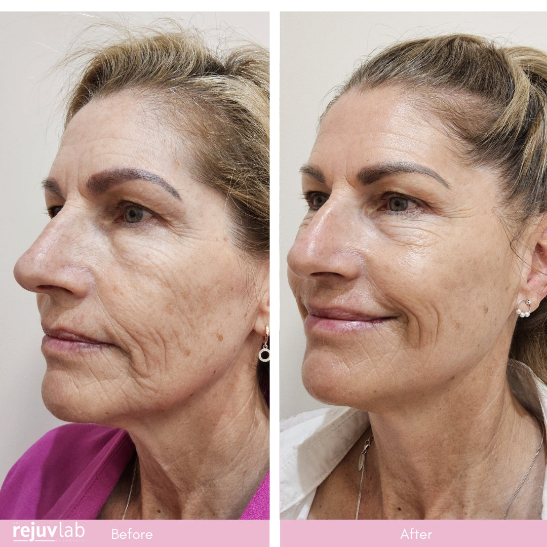 Dotless Plasma Skin Tightening 65% off – The Rejuv Lab