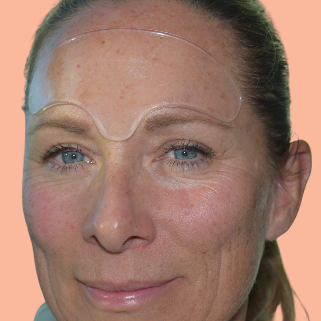 Forehead & Frown Lines Mask – The Rejuv Lab